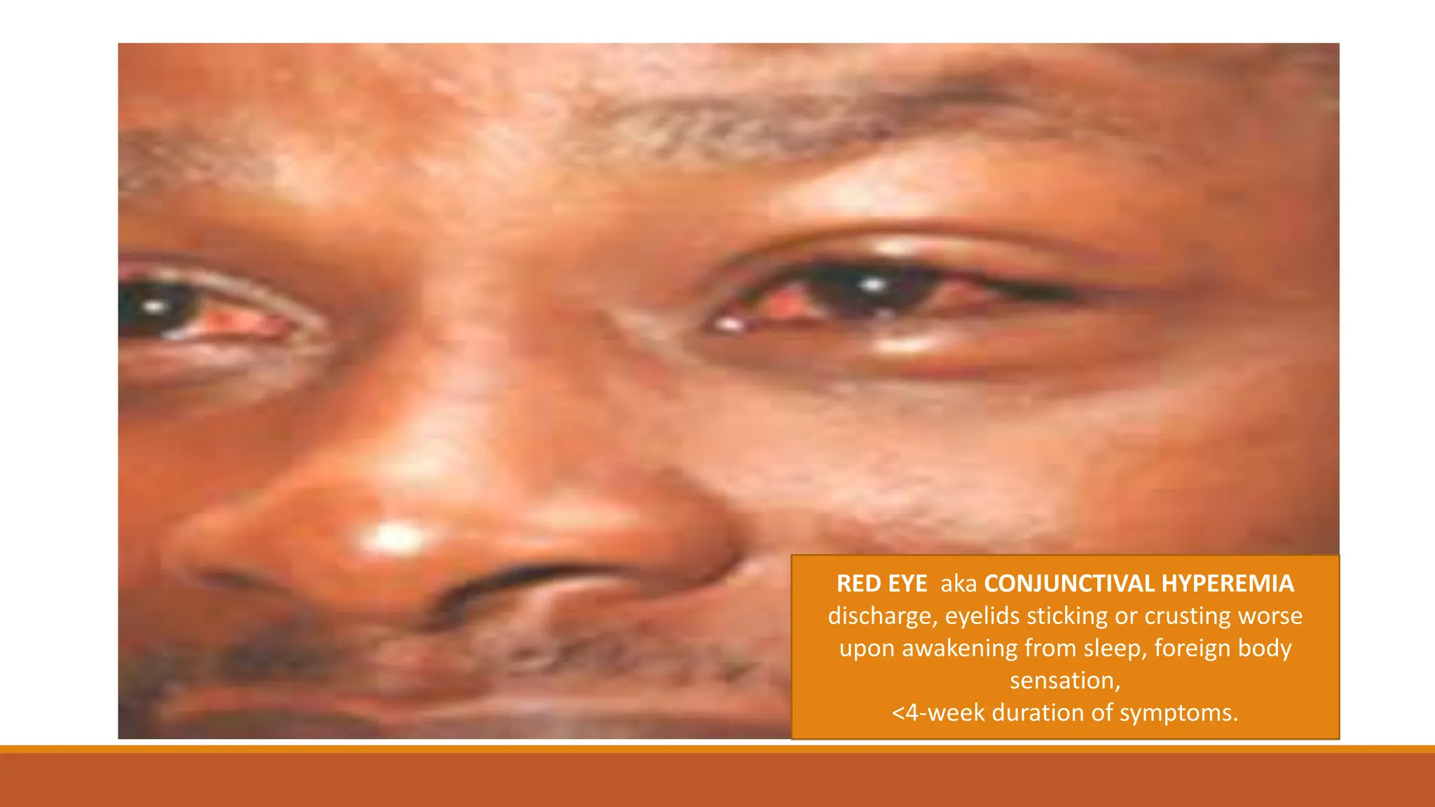 RED EYES PRESENTATION.pptx and treatment guidelines | PPT