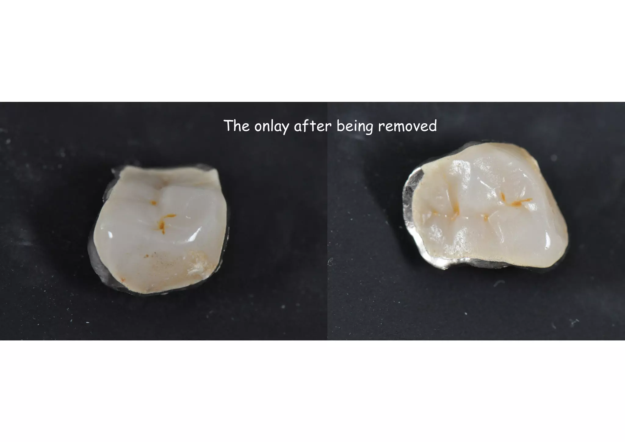 Replacement of old PFM partial crown with LiSi press onlay | PDF | Oral ...