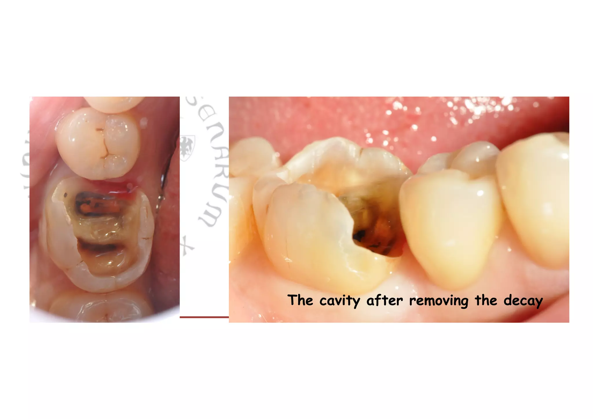 Replacement of old PFM partial crown with LiSi press onlay | PDF | Oral ...