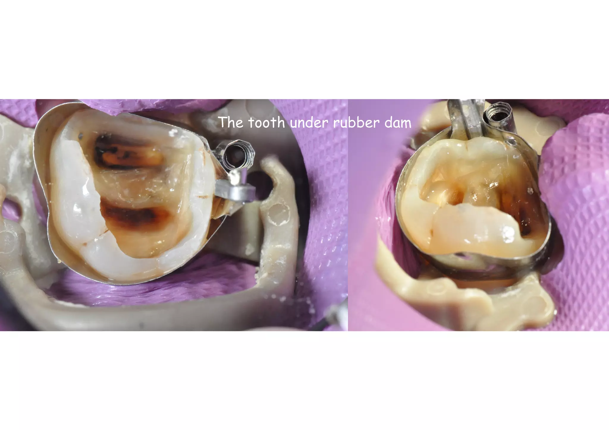 Replacement of old PFM partial crown with LiSi press onlay | PDF | Oral ...