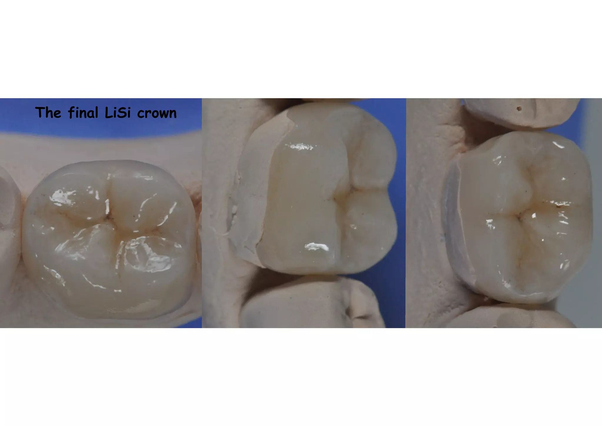 Replacement of old PFM partial crown with LiSi press onlay | PPT