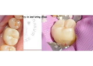 Replacement of old PFM partial crown with LiSi press onlay | PDF | Oral ...
