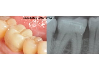 Replacement of old PFM partial crown with LiSi press onlay | PDF | Oral ...