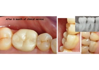 Replacement of old PFM partial crown with LiSi press onlay | PDF | Oral ...