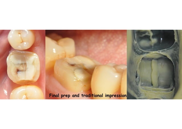 Replacement of old PFM partial crown with LiSi press onlay | PDF | Oral ...