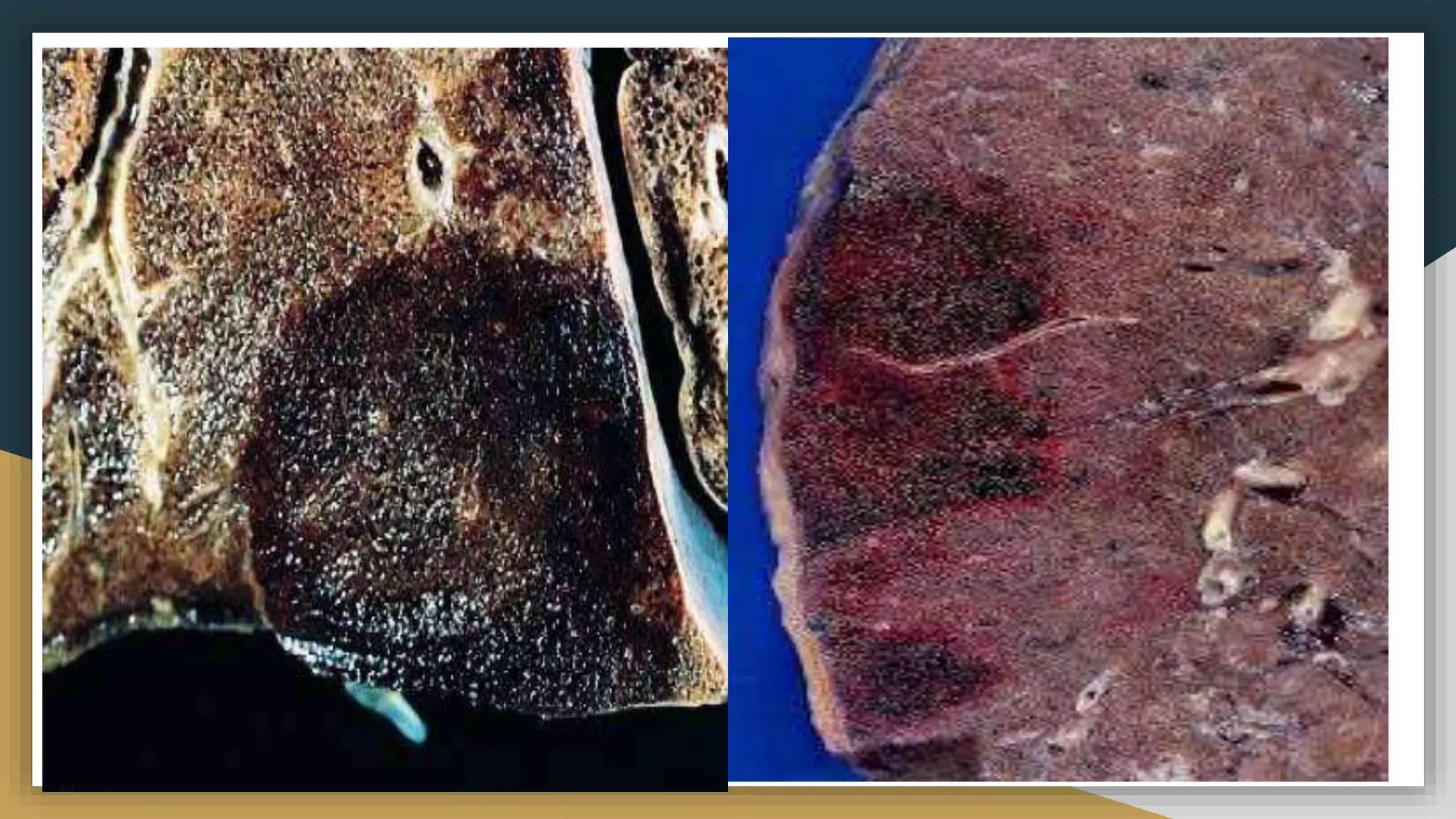 RED INFARCTS powerpoint presentation basics | PPTX