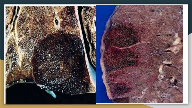 RED INFARCTS powerpoint presentation basics | PPT | Free Download