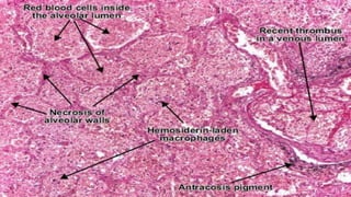 RED INFARCTS powerpoint presentation basics | PPTX