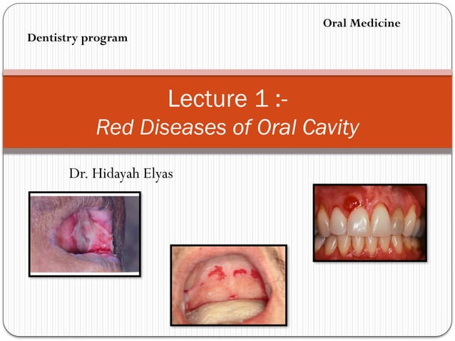 Red Lesions #1.pptx of oral cavity oral medicine | PPTX