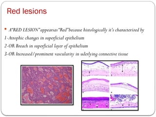Red Lesions in oral cavity oral medicine | PPT