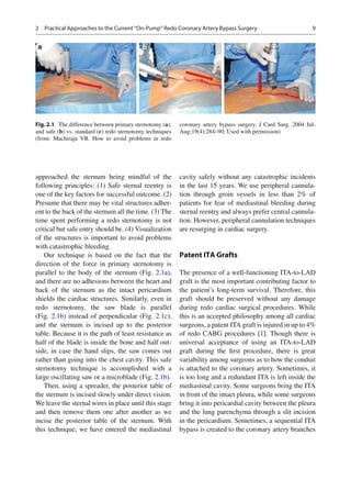 Redo cardiac surgery in adults | PDF