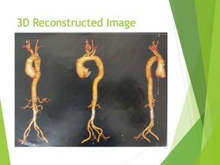 REDO cabg patent lima myocardial protection | PPT