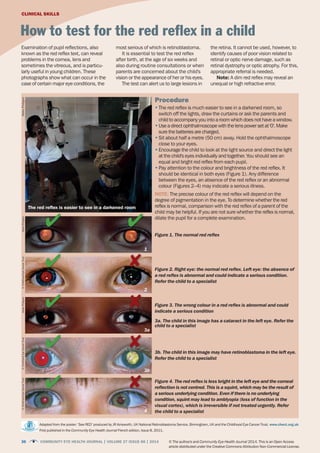 Red Reflex Ophthalmoscope