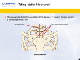 Reducing Risk of Misplaced Nasogastric Tube.pptx