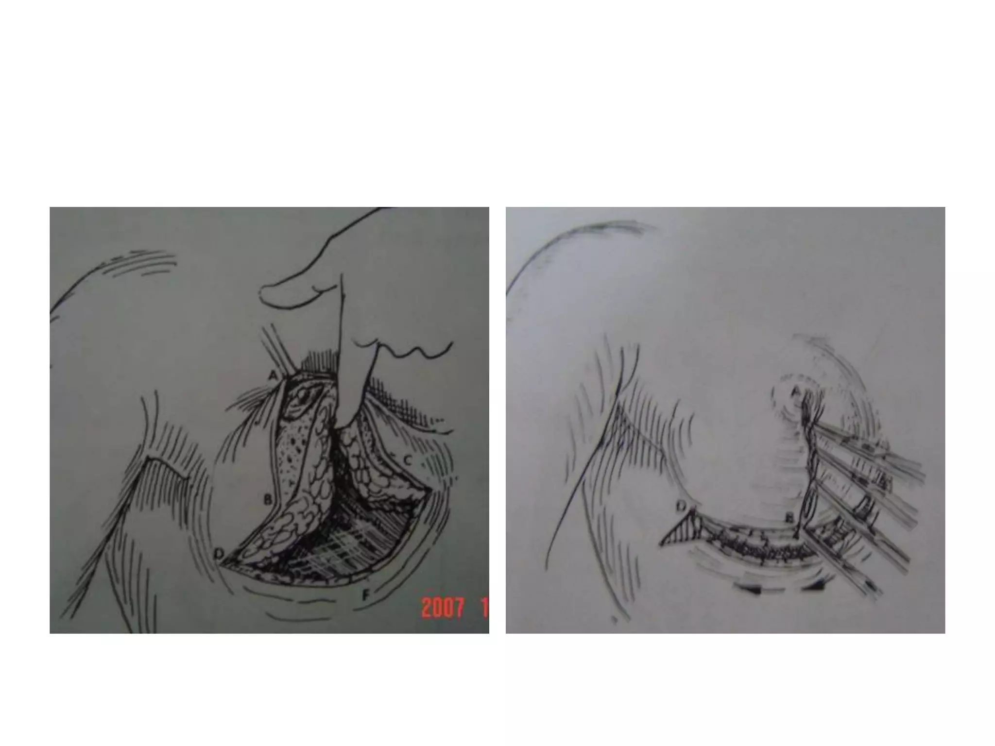 Reduction mammoplasty | PPTX