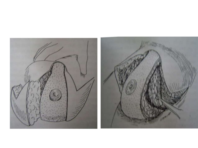 Reduction mammoplasty | PPTX