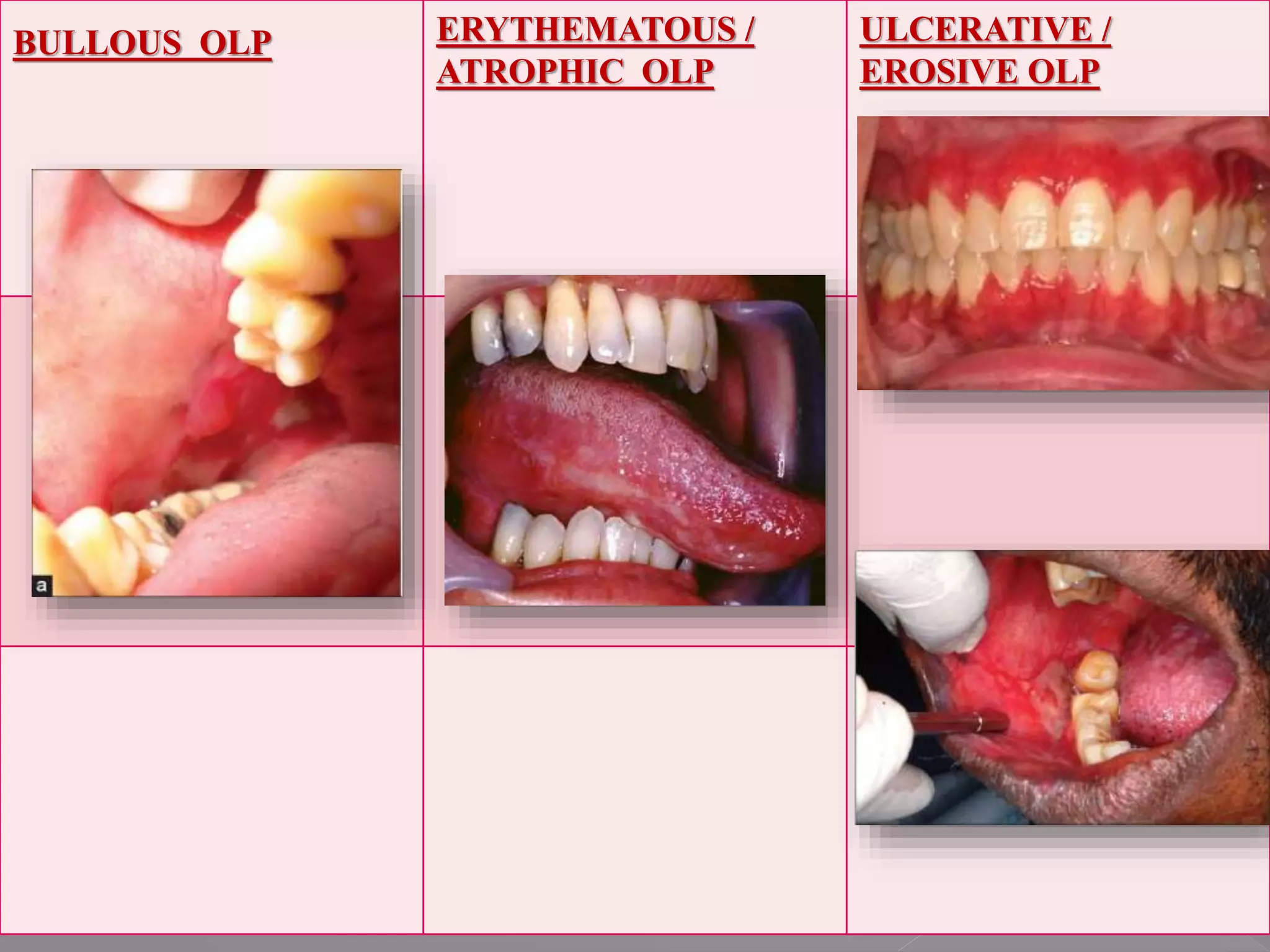 RED & WHITE LESIONS.pptx