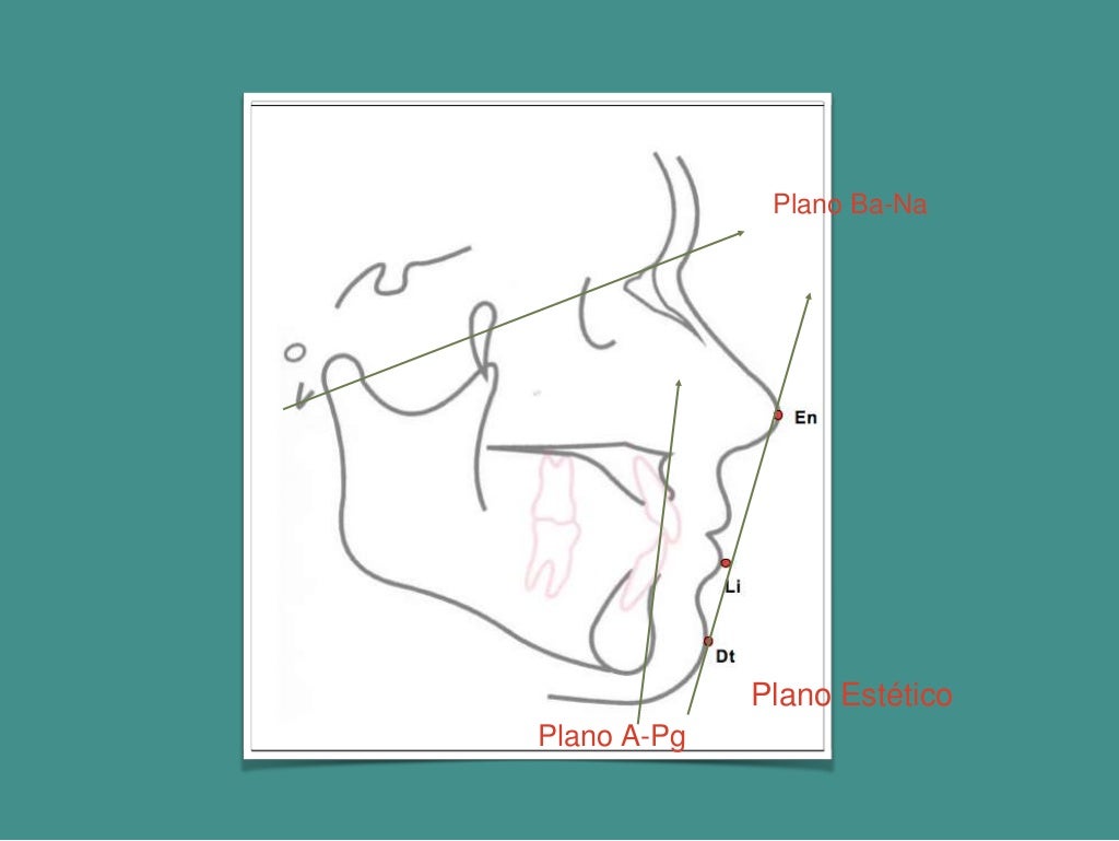 Norma lateral de Ricketts