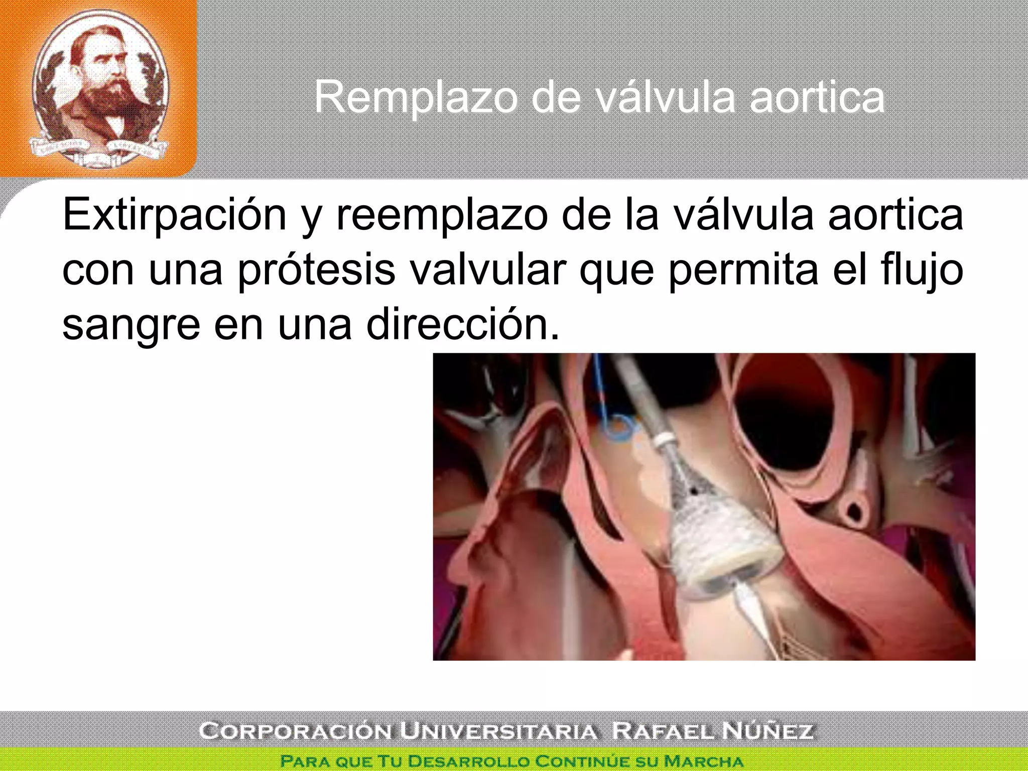 Reemplazo de valvula aortica instrumentacion quirurgica | PPTX