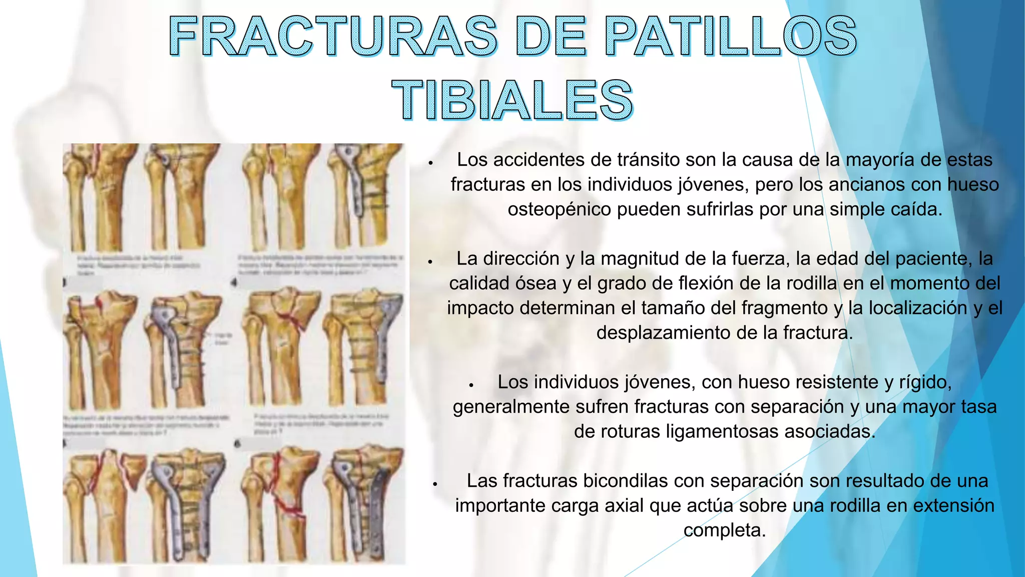 REEMPLAZO TOTAL DE RODILLA Y PLATILLOS TIBIALES | PPTX