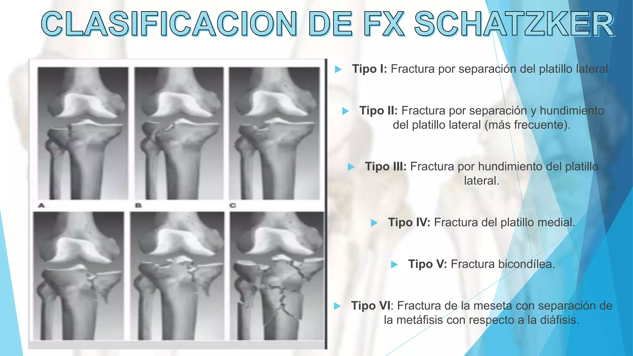 REEMPLAZO TOTAL DE RODILLA Y PLATILLOS TIBIALES | PPTX