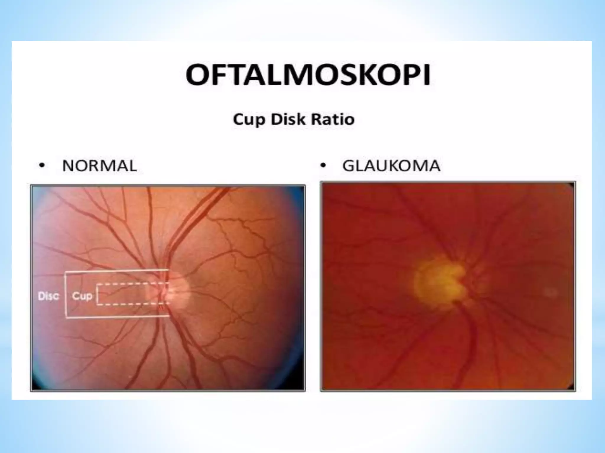 refarat glaukoma.pptx