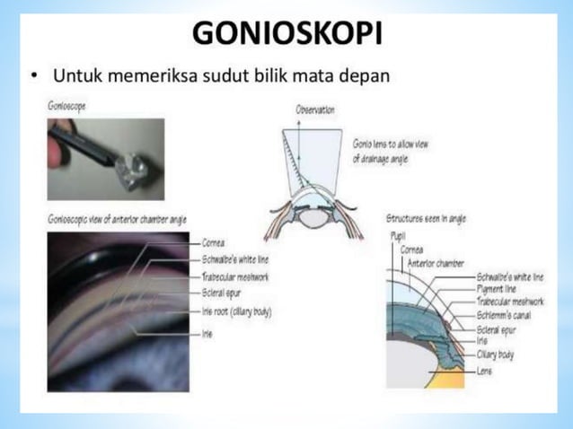 refarat glaukoma.pptx