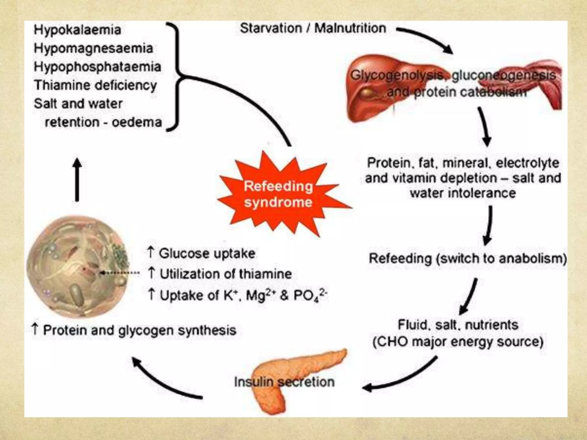 Refeeding syndrome | POTX