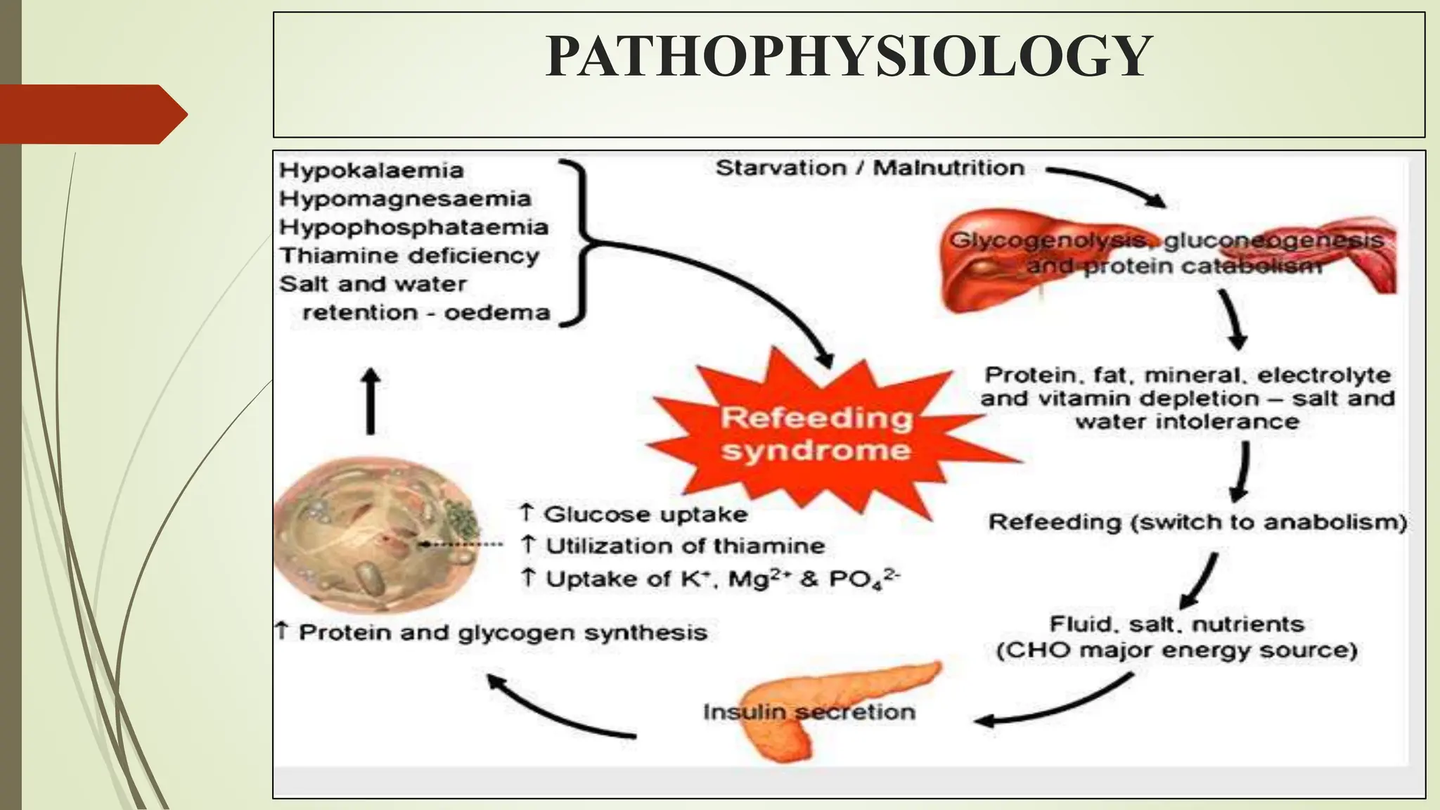Refeeding Syndrome and it's management by ASPEN | PPTX