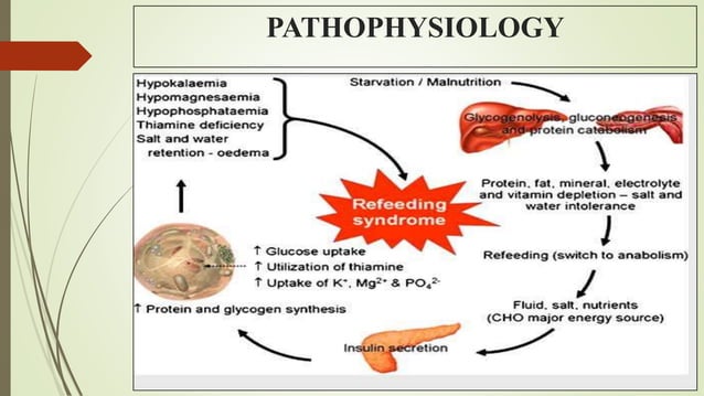 Refeeding Syndrome and it's management by ASPEN | PPTX | Blood ...
