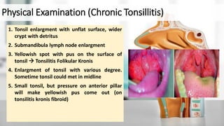 Tonsillitis | PDF