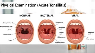 Tonsillitis | PPT