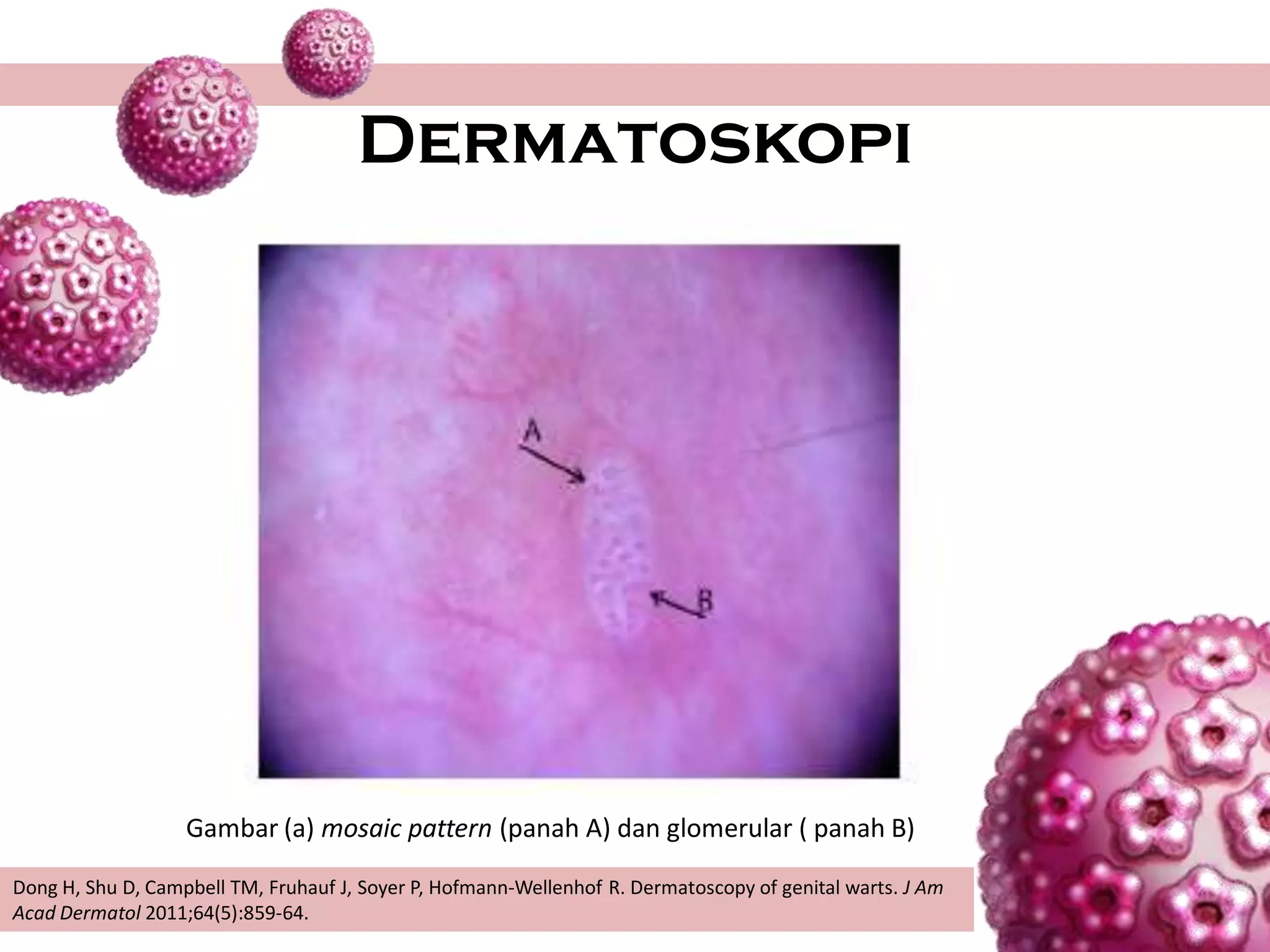 PRESENTATION kondiloma akuminata | PDF