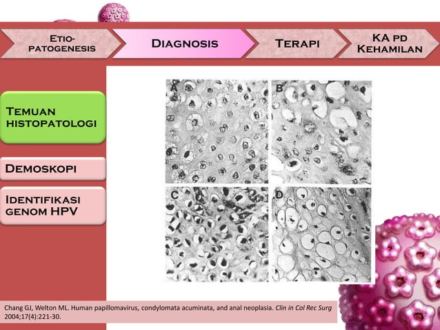 PRESENTATION kondiloma akuminata | PDF
