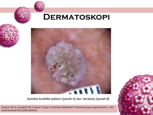 PRESENTATION kondiloma akuminata | PDF