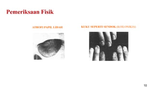 REFERAT ANEMIA BESI PADA ANAK!! [Autosaved].pptx