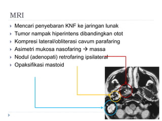 referat ca nasofaring aulia dwi juanita.pptx