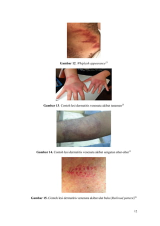 REFERAT DERMATITIS VENENATA-dr.EHD.pdf