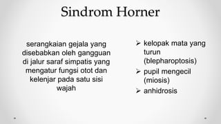 Referat mata sindrom horner jangan .pptx