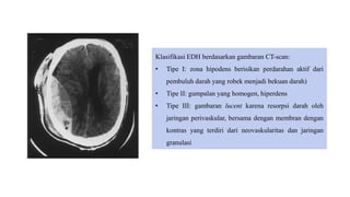 Referat Epidural Hematoma Bagian 01.pptx