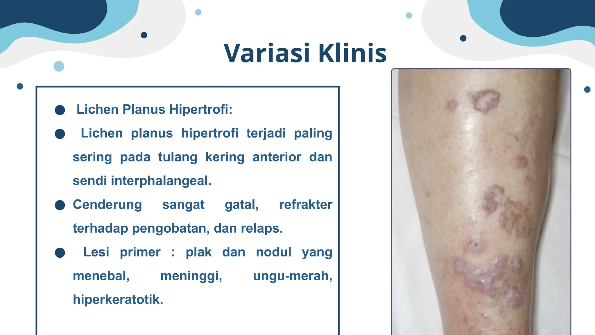 referat lichen planus.pptx referat liken planus | PPTX