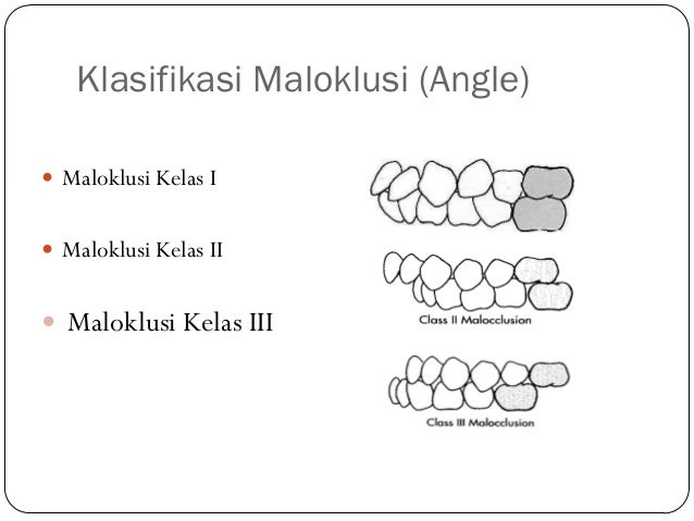 Maloklusi Tingkat 3 - Tanya Alodokter