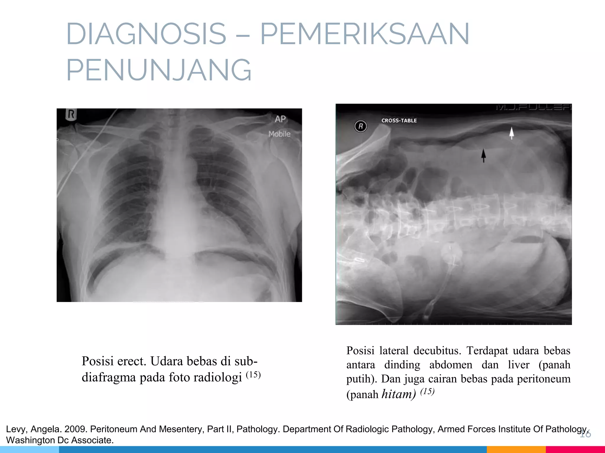 referat peritonitis.pptx
