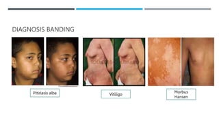 referat Pitiriasis versikolor.pptx