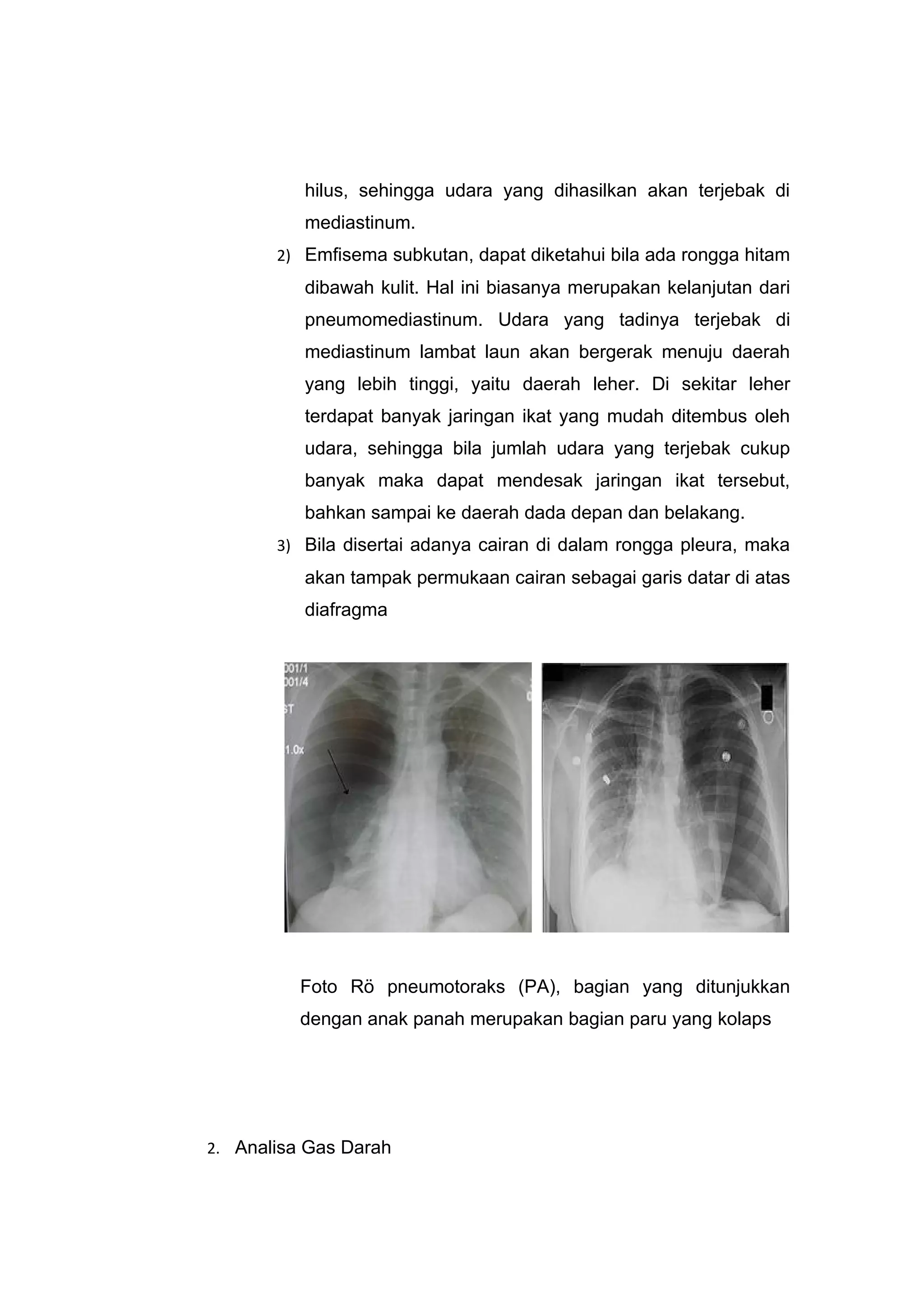 Referat pneumothorax | DOC