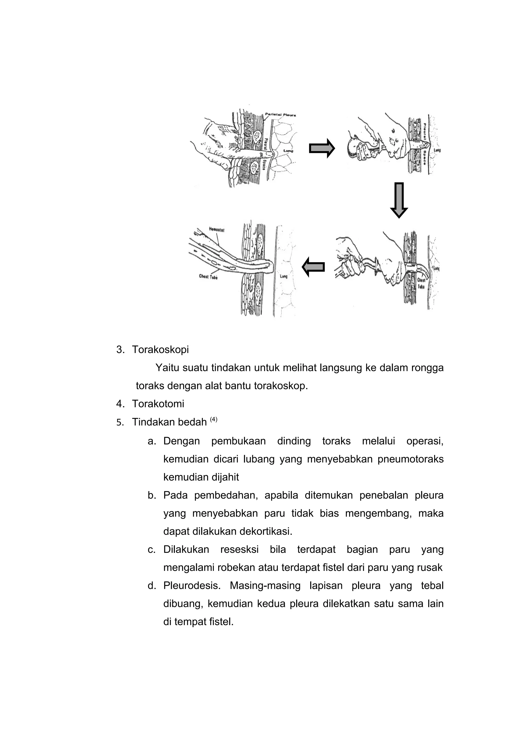 Referat pneumothorax | DOC