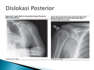 Referat_radiologi_dislokasi_bahu.pptx