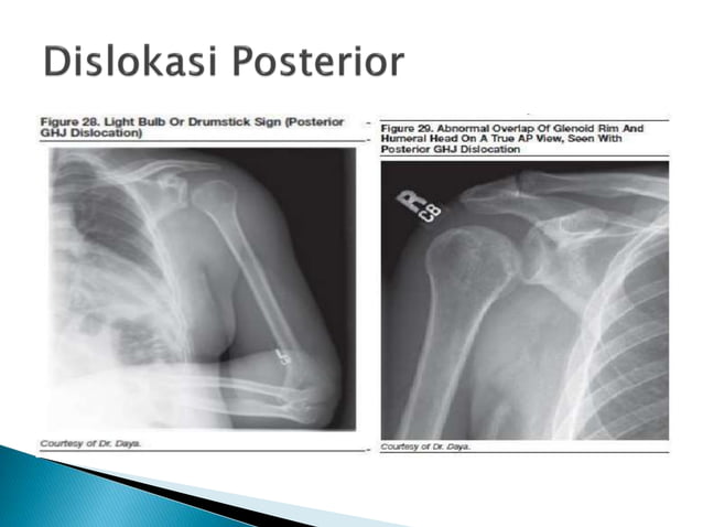 Referat_radiologi_dislokasi_bahu.pptx