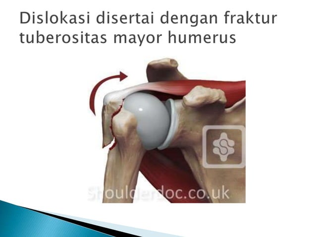 Referat_radiologi_dislokasi_bahu.pptx