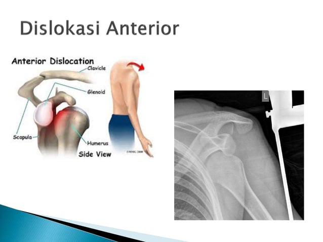 Referat_radiologi_dislokasi_bahu.pptx